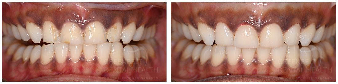 Cosmetic Tooth Filling Austin TX - Cavities Solution